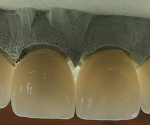 Cosmetic All Ceramic Restorations – Subtechdental